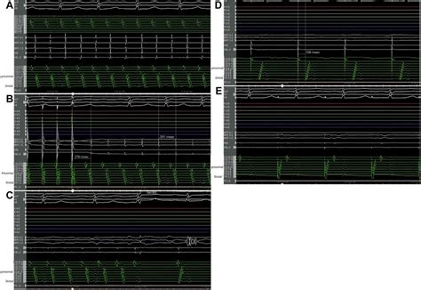A Clinical Flutter Circuit B Entrainment From Ablation Catheter At 3 Download Scientific