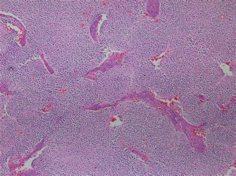 Medulloblastoma Pathology Outlines