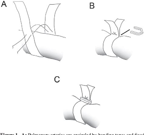 Figure 1 From Fontan Completion Following Flow Adjustable Bilateral