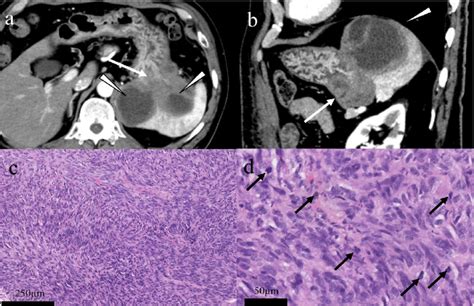 High Risk Gastrointestinal Stromal Tumor Spindle Cell Type A Download Scientific Diagram