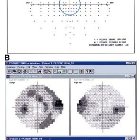 Esterman Visual Field Test Output From The Humphrey Visual Field Download Scientific Diagram
