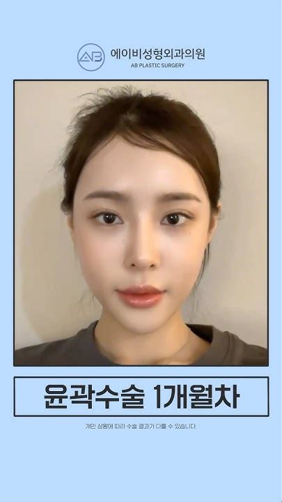 윤곽수술광대사각턱 후기 Shorts Youtube