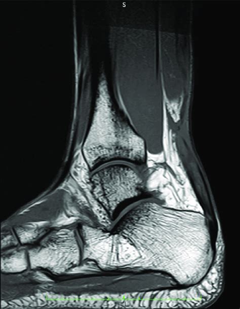 T1 Weighted Spin Echo Sagittal View Sagittal View With A Complete Tear Download Scientific