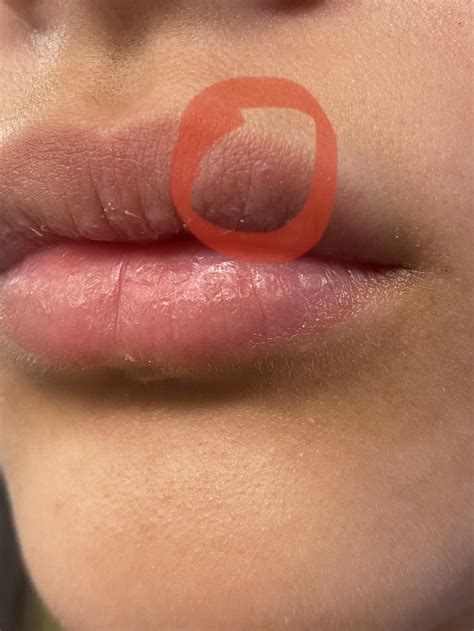 Tiny Bump On My Lip Is It Cold Sore Rdermatologyquestions