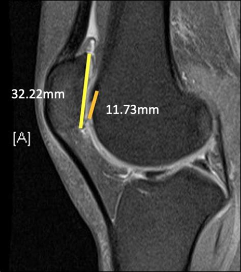Right Knee Sagittal Mri Articular Overlap Pti Patellotrochlear Download Scientific Diagram