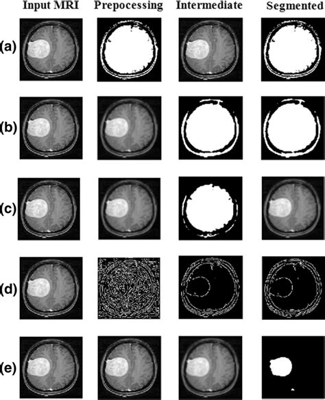 Visual Segmentation Results Of Benign Tumor On T1w Mr Image Using A