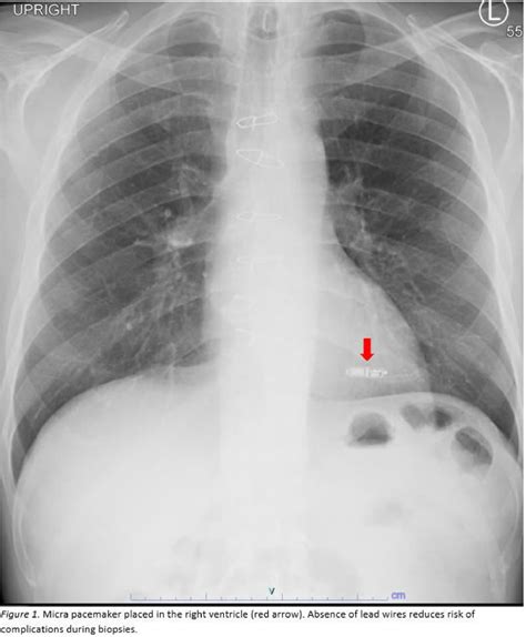 Utilization Of Leadless Pacemaker During Index Hospitalization