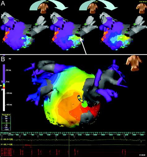Atrial Tachycardia After Ablation Of Persistent Atrial Fibrillation
