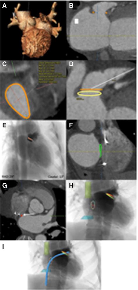 Preprocedural Multimodality Imaging In Atrial Fibrillation Circulation Cardiovascular Imaging