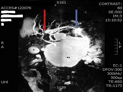 Figure 1 From Spontaneous Biloma Due To An Intrahepatic