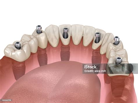 만능 보철제 모든 4 시스템에 임플란트 나사 고정에 의해 지원 치과 개념의 의학적으로 정확한 3d 일러스트 Edentulous에 대한 스톡 사진 및 기타 이미지 Istock