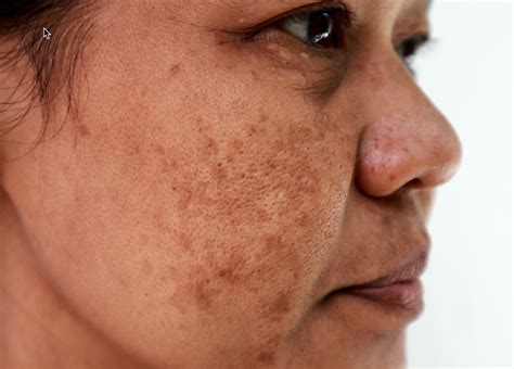 Melasma — Medical Secrets