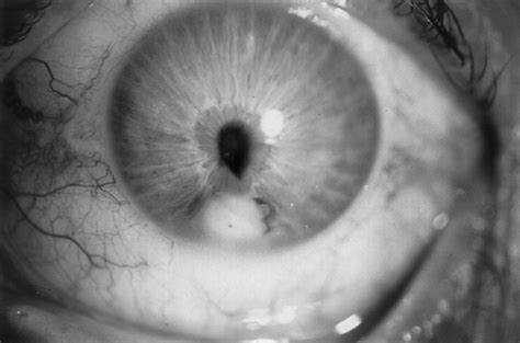 Anterior Segment Photograph Of The Other Patient Showing Similar Download Scientific Diagram
