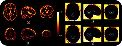 Figure From Mri To Pet Cross Modality Translation Using Globally And Locally Aware Gan Gla