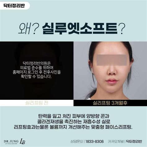 실리프팅 팔자주름없애기 실루엣소프트 실리프팅효과 통증 가격 부작용 후기 닥터정리반 Youtube