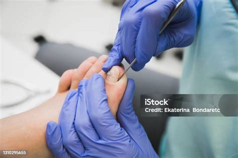 네일 클립 포디에이트리스트가 자란 발톱을 취급합니다 의료 페디큐어 절차 오토닉스 브래킷 족부전문의에 대한 스톡 사진 및 기타 이미지 Istock