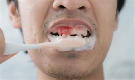 양치할때 피 나는 이유 출혈이 많거나 잦다면 잇몸 및 치아 구강 건강 정도 및 양치질 방법 칫솔질 및 제품 사용 팁