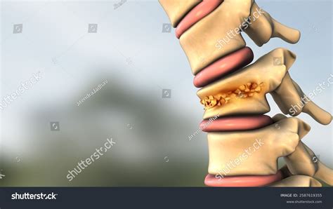 Spinal Wedge Known Wedge Fracture Compression Stock Illustration
