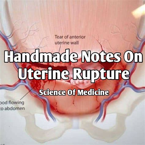 Science Of Medicine Uterine Rupture Understanding The Causes