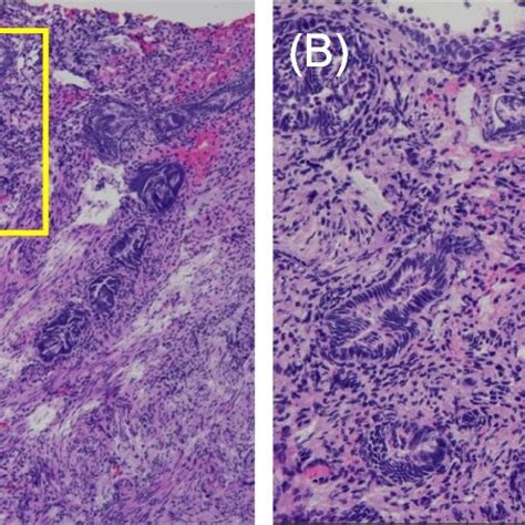 Histological Examination Of The Surgical Specimen Identified
