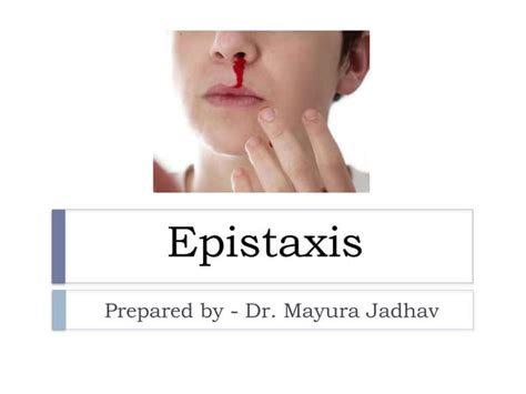Epistaxis Pptx Bleeding Through Nose Know The Treatment Ppt