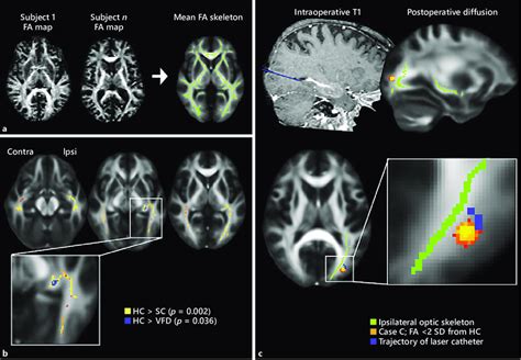 Optic Tract Based Voxel Wise Fractional Anisotropy Fa In Patients