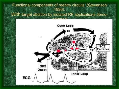 Long Term Post Ventricular Tachycardia Ablation Guided By Non Contact Mapping System In A Single