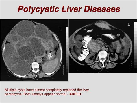 PPT Diffuse Liver Disease PowerPoint Presentation Free Download ID 6644888