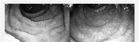 Endoscopic Markers Of Celiac Disease In The Descending Duodenum