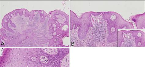 Clear Cell Acanthoma Histology