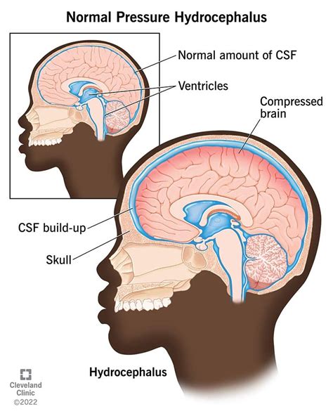 Normal Pressure Hydrocephalus Nph Symptoms Treatment Artofit