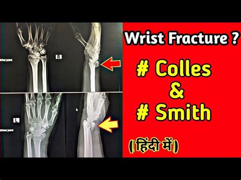 Smith Fracture