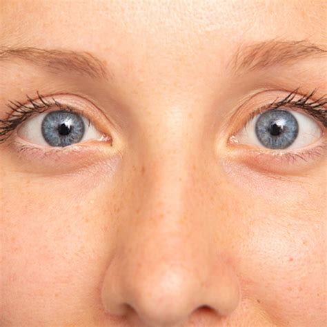 Strabismus Surgery Atlas University Hospital İstanbul