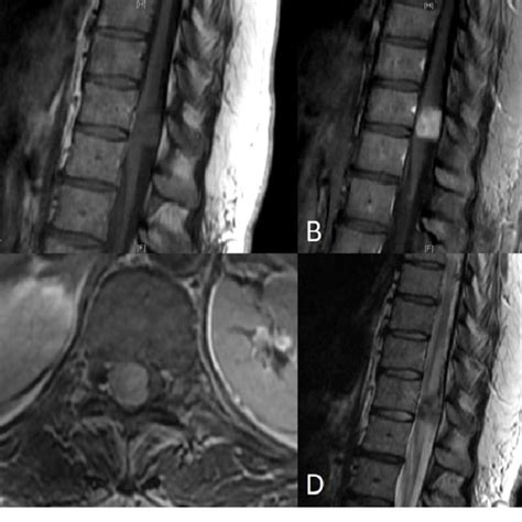 Preoperative Mri Thoracic Spine Sagittal T1 Precontrast A