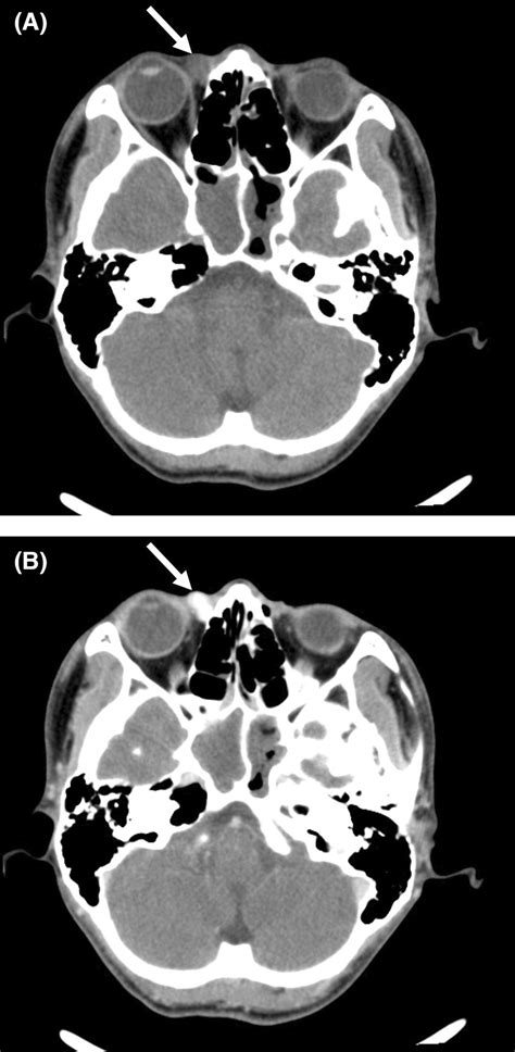 Imaging Findings Of Superficial Angiomyxoma In The Eye Socket Chen
