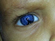 1000 Images About Coloboma On Pinterest The Iris Irises And Eyes