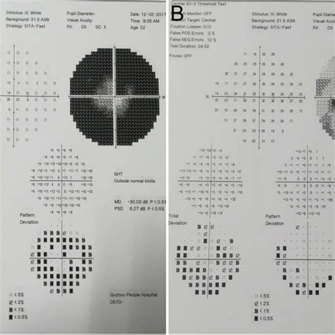Visual Field A The Right Eye Showed A Tubular Visual Field B