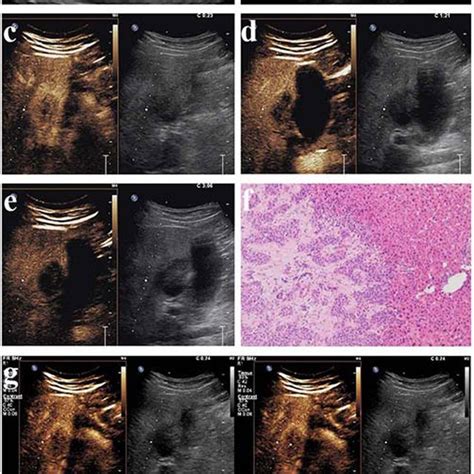 Intrahepatic Cholangiocarcinoma Icc In A 62 Year Old Male See