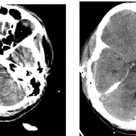 Antero Posterior Rt Temporal Hematoma Evacuated Surgically In Patient