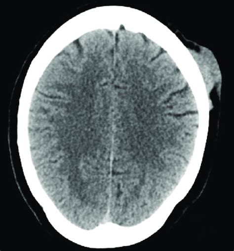 The Appearance Of The Lesion Which In The Left Temporoparietal Region