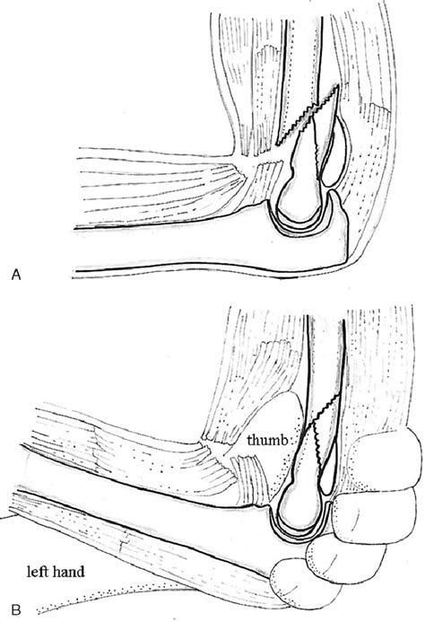 Open Reduction Procedure A And B The Displacement Of The Fracture Download Scientific