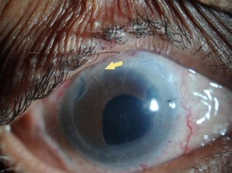 Valve Surgery Glaucoma Valve Surgery