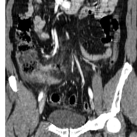 Normal Appendix A B Transverse Gray Scale Us Images With A And