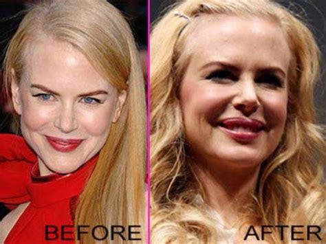 bästa bilderna om Botox mistakes på Pinterest Gwyneth paltrow Nicole kidman och Kylie minogue