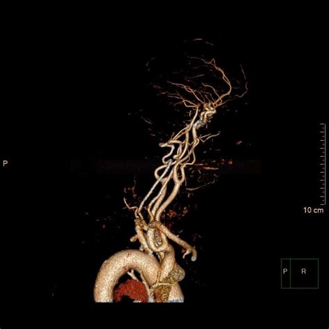 Ct Angiography Cta Stroke Manual