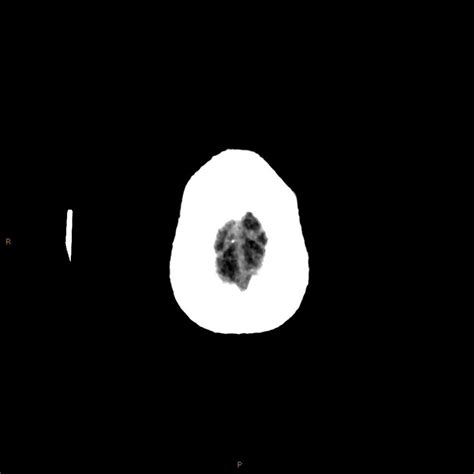 Basal Ganglia Hemorrhage With Intraventricular Extension Radiopaedia