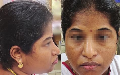 Clinical Image Showing Subtle Facial Dysmorphic Features Download Scientific Diagram