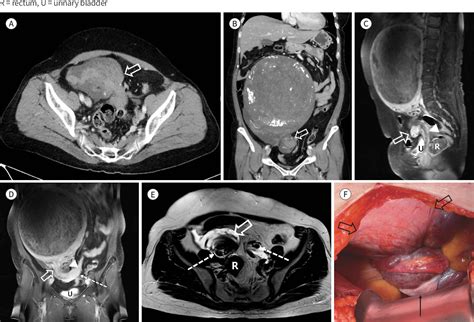 Figure 1 From 비임신 여성에서의 자궁근종에 의한 자궁염전 증례 보고 Semantic Scholar