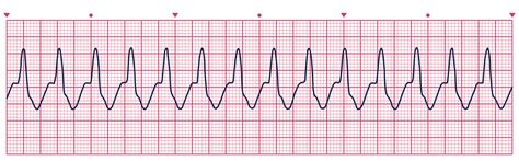 What Is V Tach On Ecg At Kevin Davidson Blog