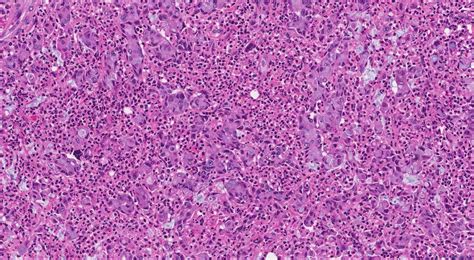 Goblet Cell Adenocarcinoma Archives Ottawa Atlas Of Pathology Goblet Cell Adenocarcinoma Archives Ottawa Atlas Of Pathology